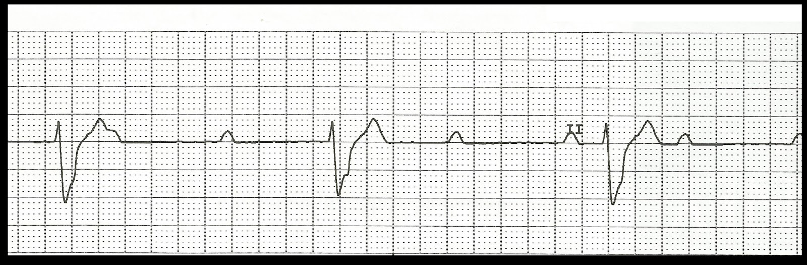Float Nurse: Basic EKG Rhythm Test 04