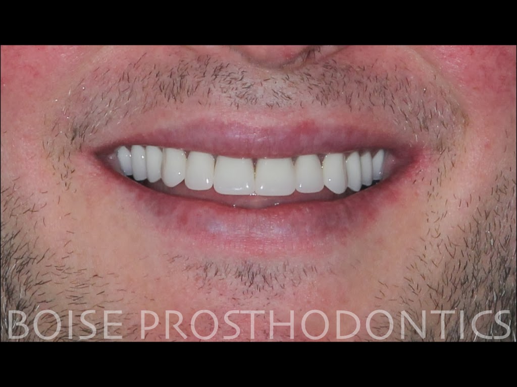 Boise Idaho Prosthodontics: True Immediate Maxillary Complete Denture ...