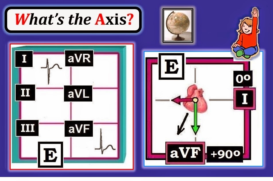 ECG Interpretation: ECG Blog #203 (ECG MP-20,21) — AXIS & Hemiblocks ...