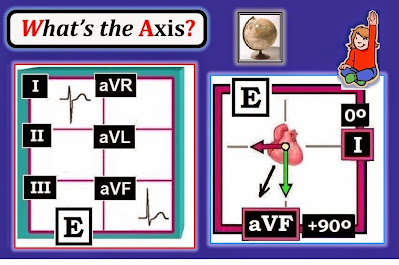 ECG Interpretation: ECG Blog #203 (ECG MP-20,21) — AXIS & Hemiblocks ...