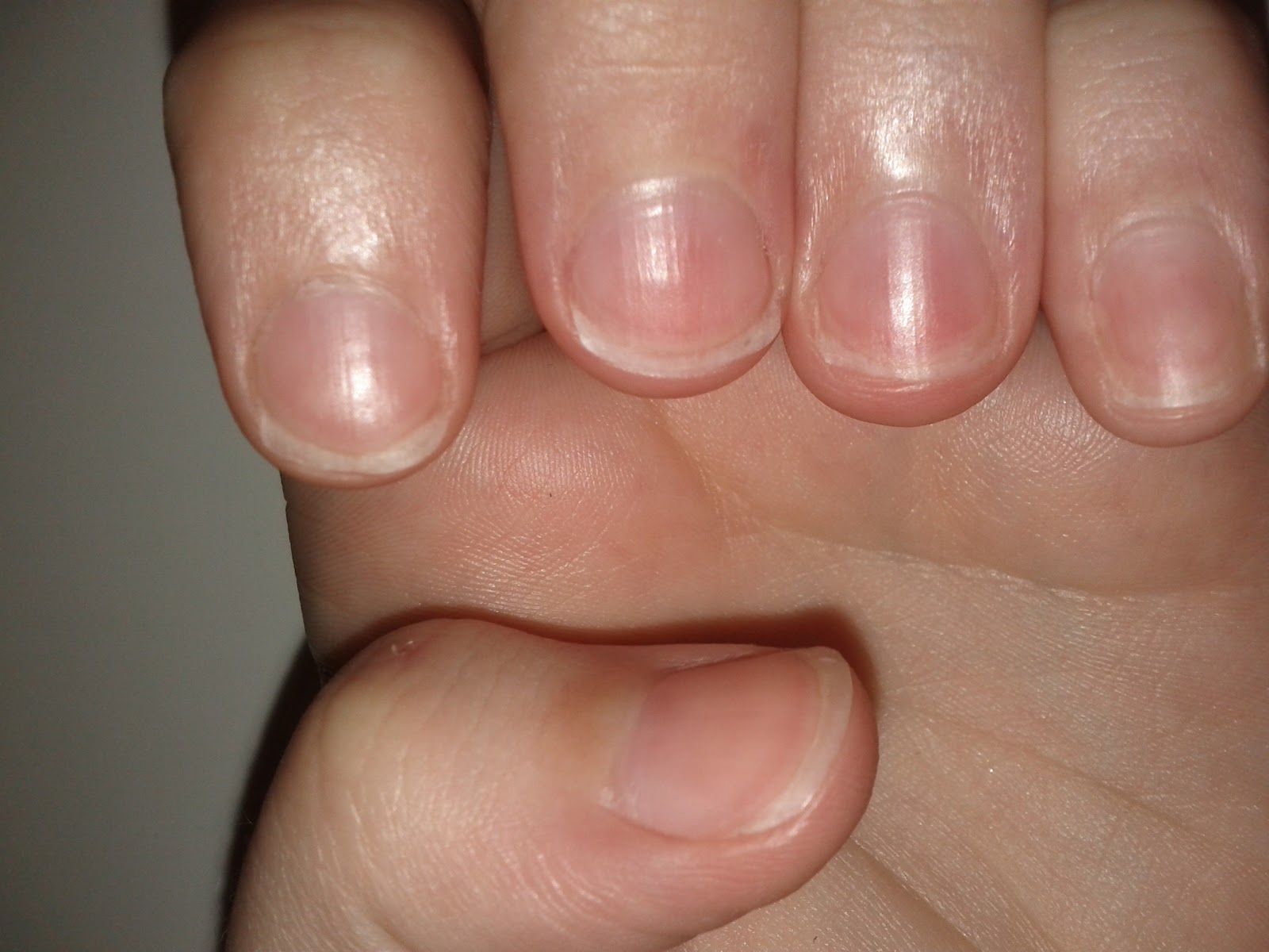 My Troublesome Nails