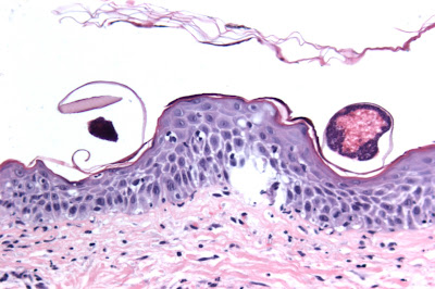 PREDICT: Καρκίνος αιδοίου