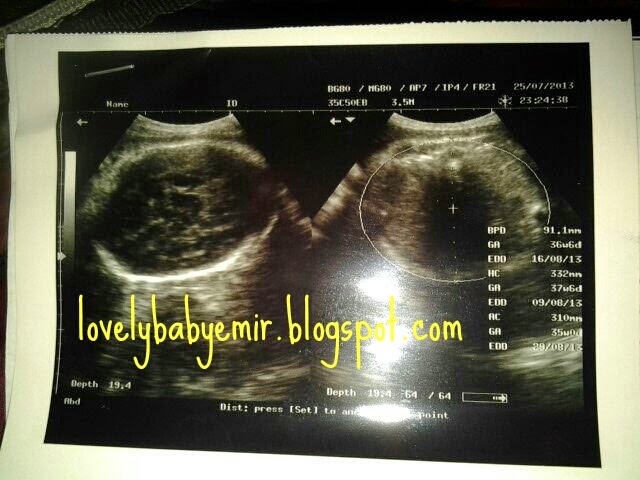 baby emir journey: Hasil USG dan Cara Membacanya