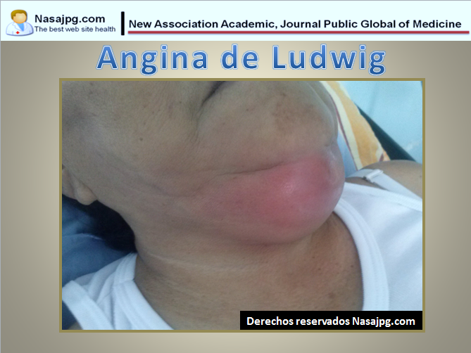 MEDICINA: Angina de Ludwig
