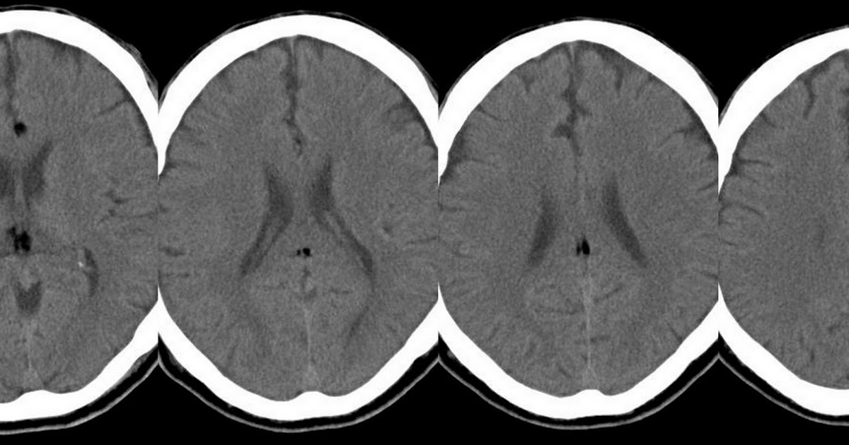 Neuroradiology Cases: Corpus callosal Lipoma