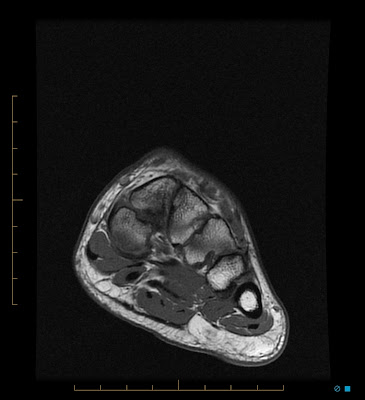 Radiology Cases: Bipartite Medial Cuneiform, Fibrous Coalition, Stress ...