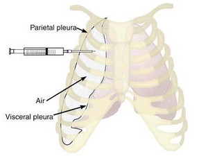 Tracheal Deviation - Causes and Treatment