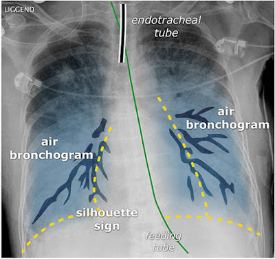 Air bronchogram
