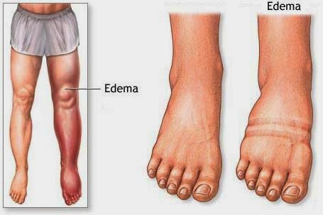 DIET TREATMENT TO ALLEVIATE EDEMA ~ Natural Fitness Tips