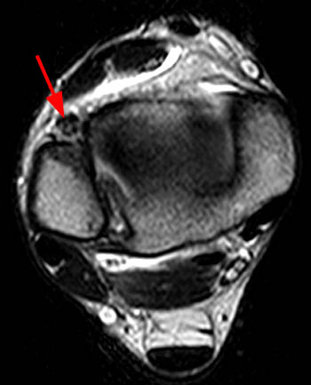 MRI Musculo-Skeletal Section: High ankle sprains.