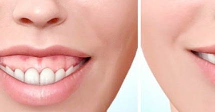 Botox, Acido Hialurónico, Bichectomia, Invisible Touch Hilos Pdo