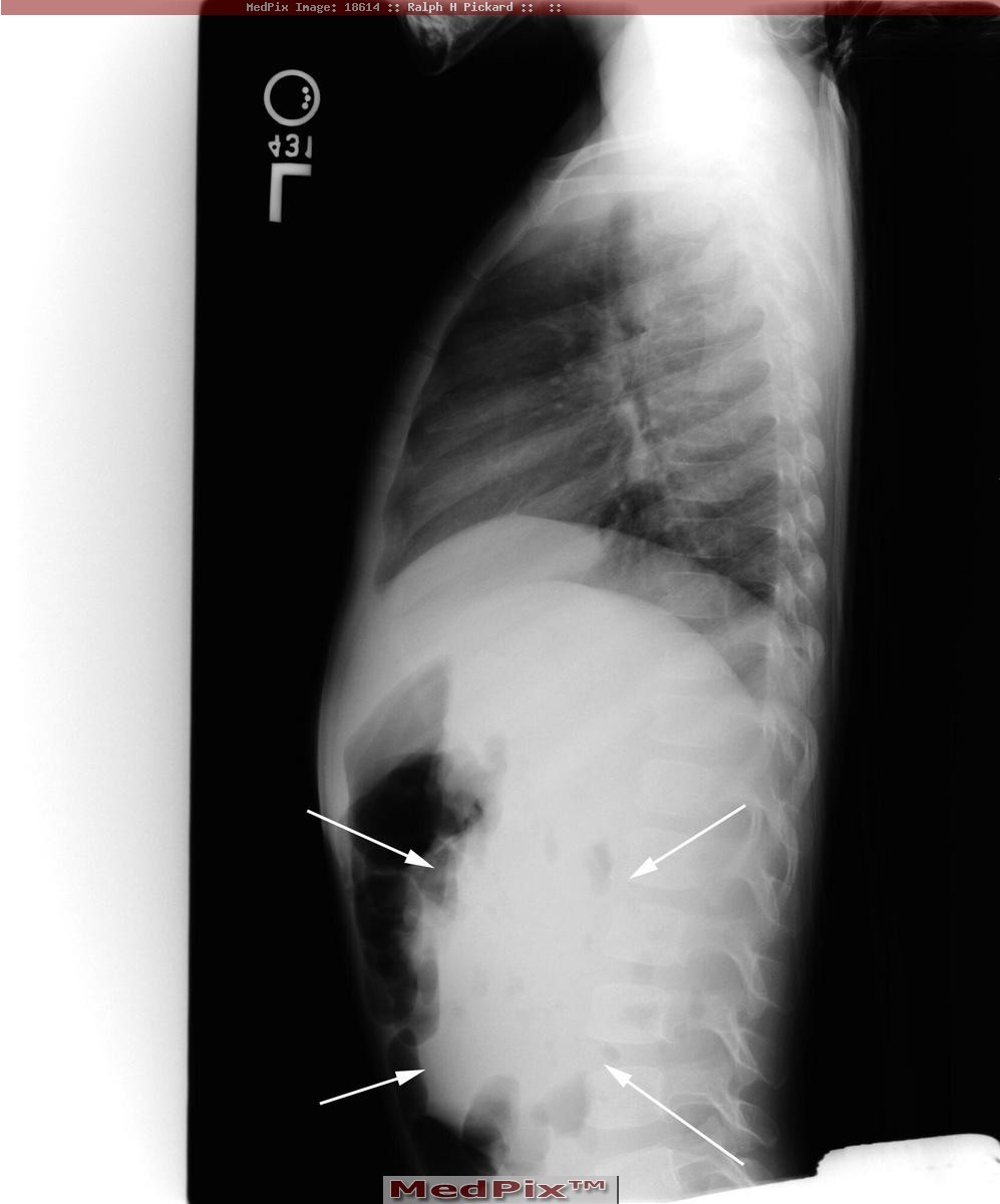 Tumor-Karzinome: Hepatoblastom