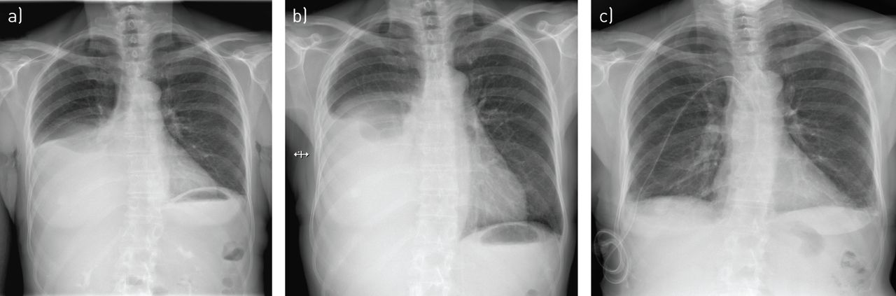 Asbestos pleural disease - Health Care Gove