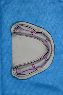 Understanding Prosthodontics - Tagore Dental College & Hospital-By ...
