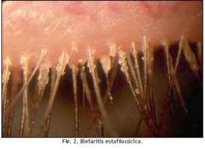 The Patient's Guide to Dry Eye Syndrome: Meibomian Gland Dysfunction ...