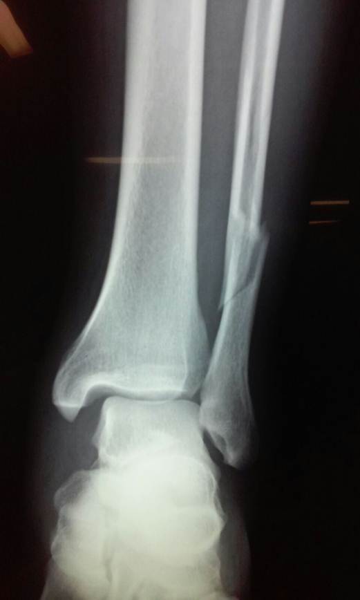 O R T O C R I T I C A: Fractura de tobillo: lesion de sindesmosis y del ...