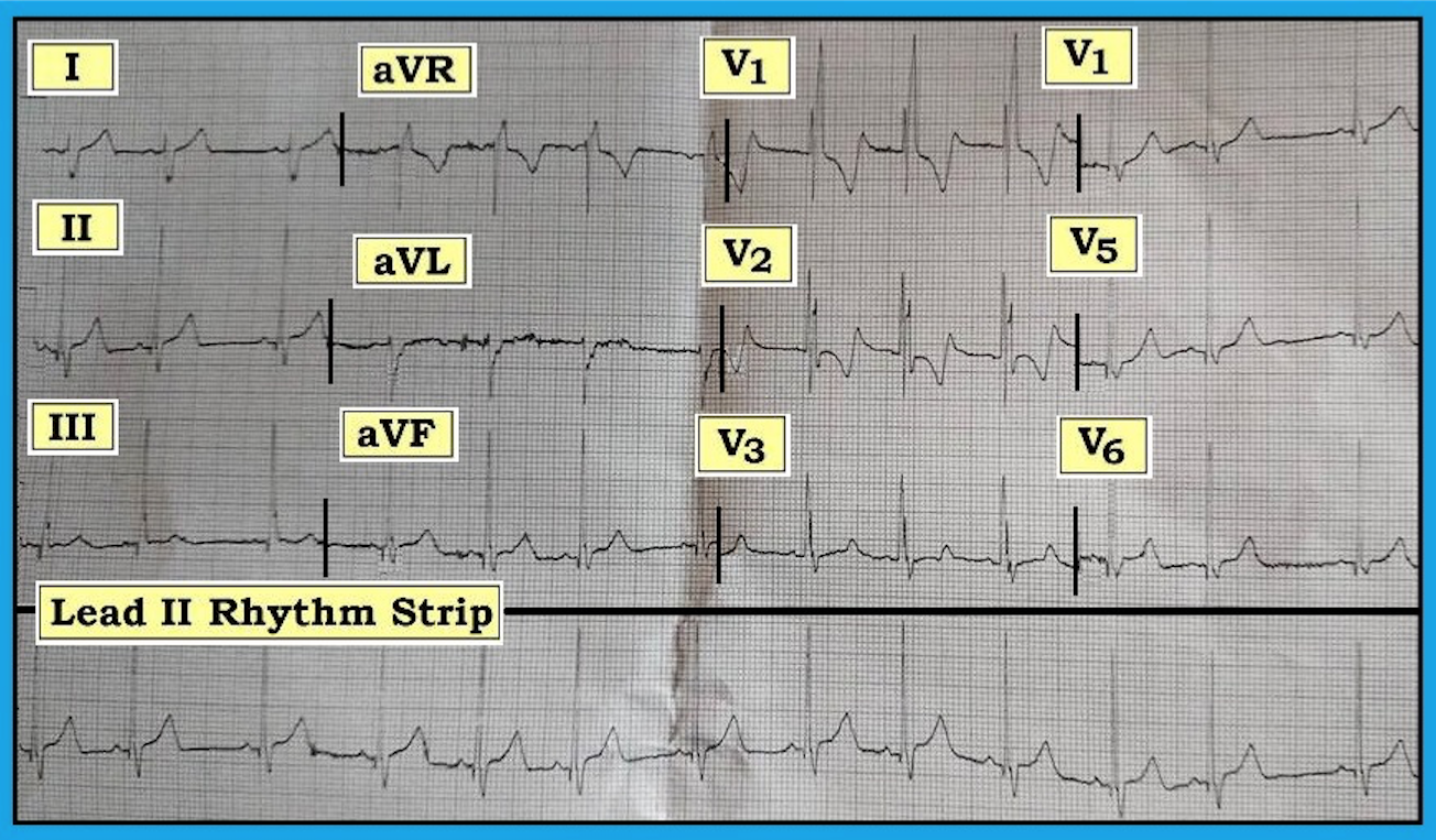 ECG Interpretation: ECG Blog #122 (RBBB - LPHB - Congenital Heart ...