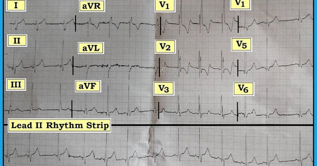 ECG Interpretation: ECG Blog #122 (RBBB - LPHB - Congenital Heart ...