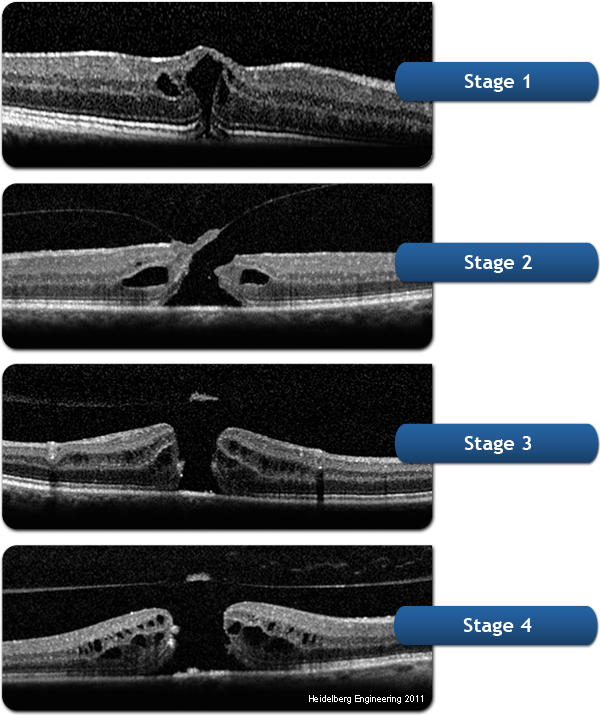 Macular Hole Stages | Macular Hole Surgery