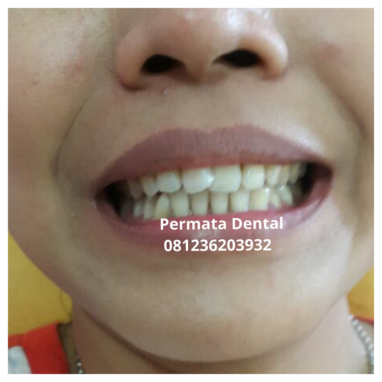 DOKTER GIGI BALI: Behel | Barcket | Kawat Gigi Perawatan