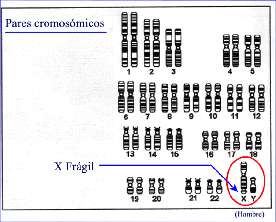 Psicología Clínica: El sindrome del X Frágil