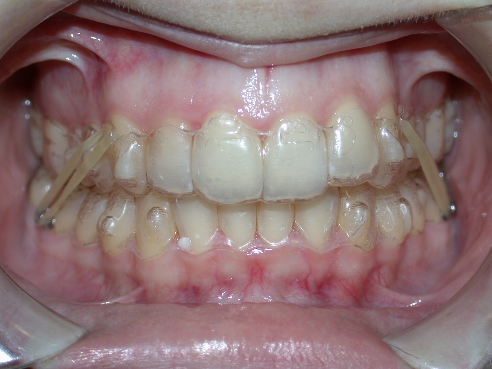 Diario de mi Invisalign: ¡Dos aligners más!