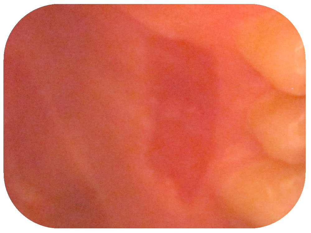 Gum Graft Experience Two Weeks Later : Behind Mytutorlist.com