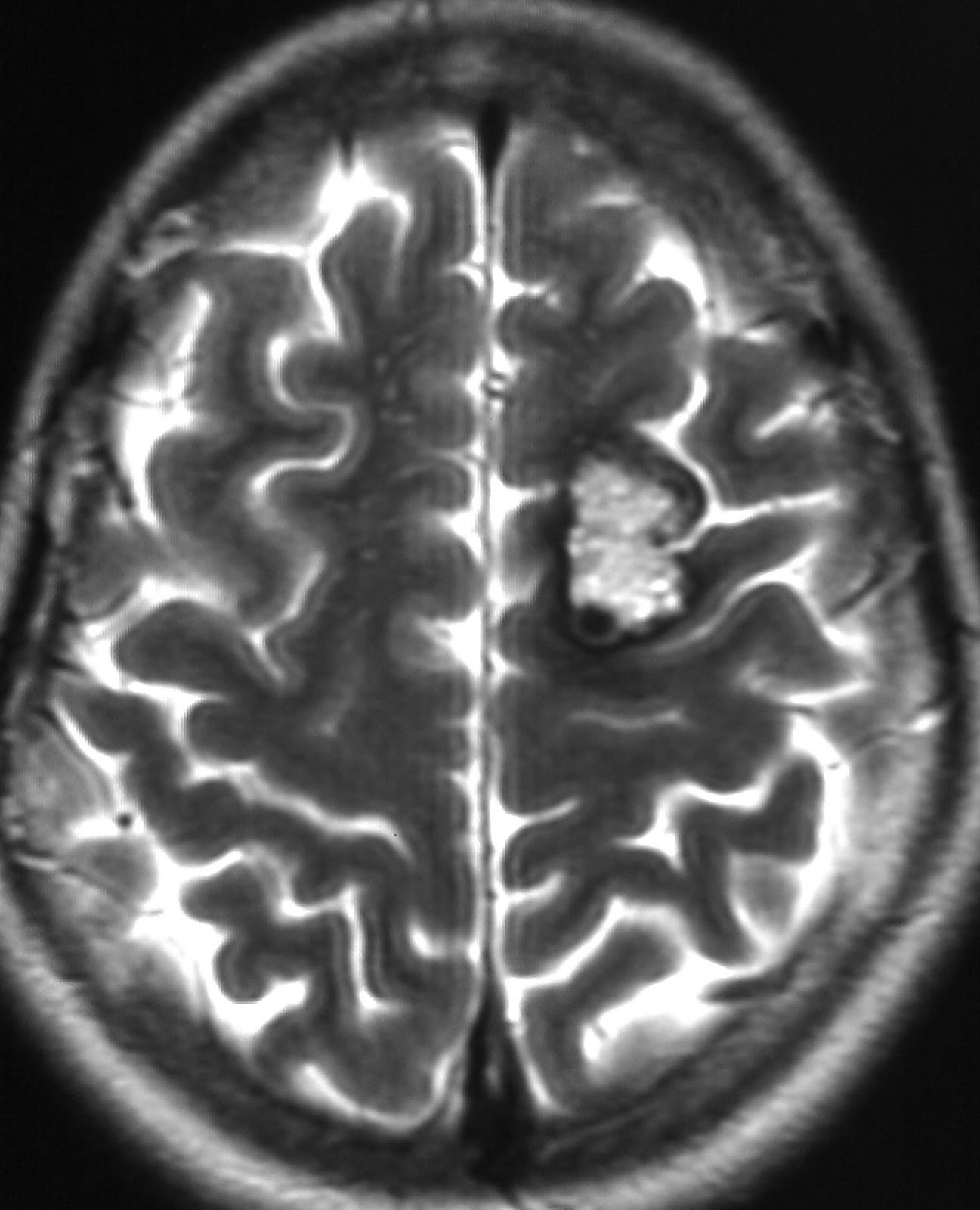 Cavernous Angioma - Pictures