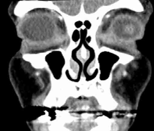 Ct Of Scleral Plaques
