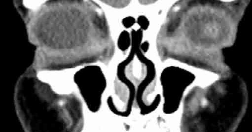 Neuroradiology Cases: Orbital Calcifications