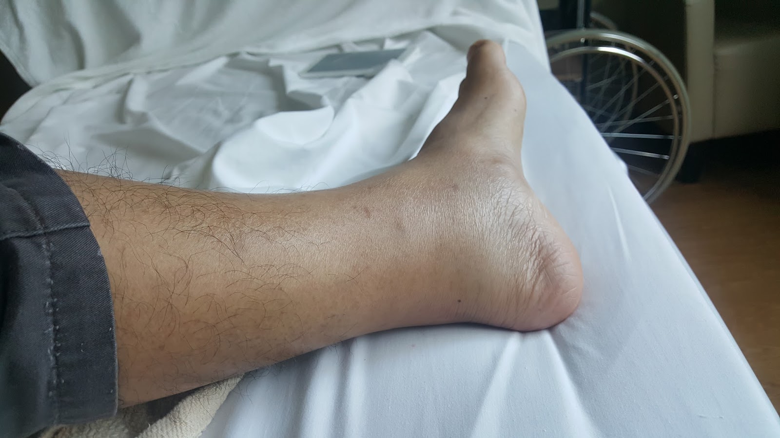 Tanakampung: Putus Urat Keting (Achilles Tendon Rupture)