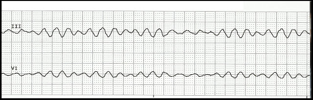 Pulseless VF/VT Part 1