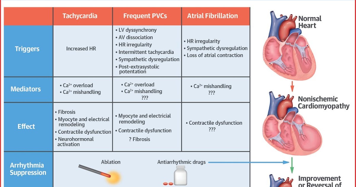 Orion Cardiology, PLLC : Arrhythmia-Induced Cardiomyopathy