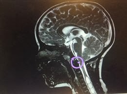 Children's Chiari Journal: CSF Flow Study part 1