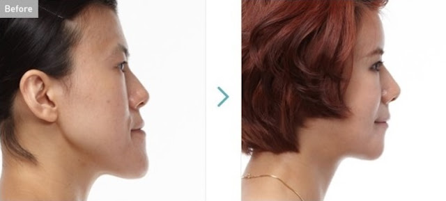Plastic Surgery in Korea : Which Way of Two Jaw Surgery Would Suit Me?