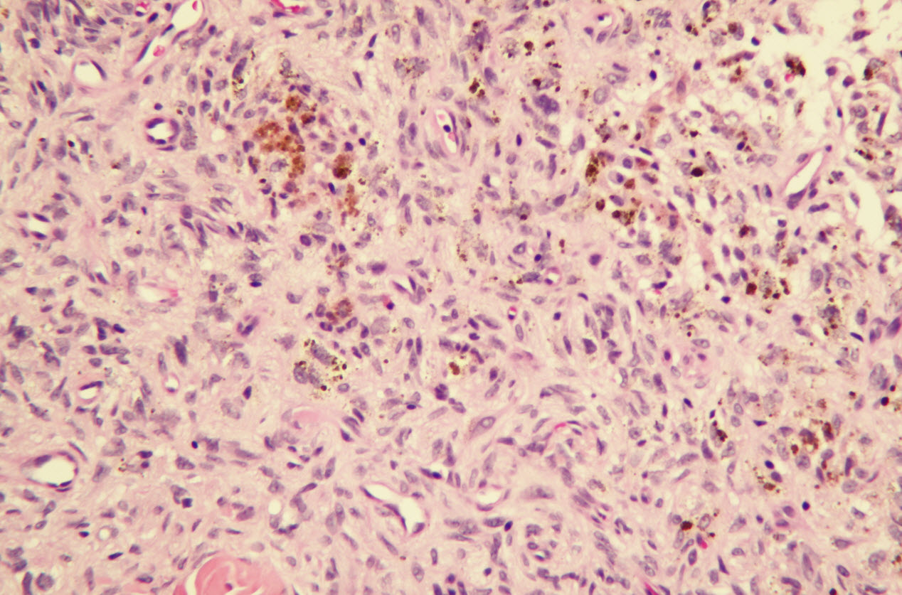 Dermpath Made Simple - Neoplastic: Dermatofibroma