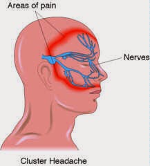 cluster-headache.jpg