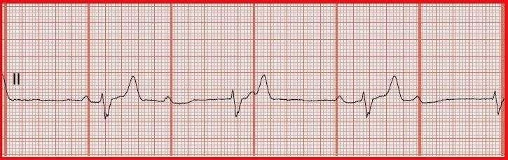Various Third Degree Heart Blocks