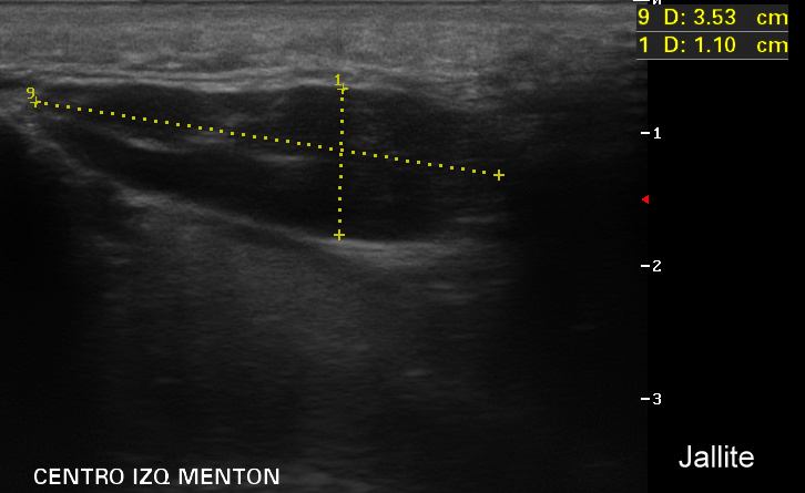 Abscesos Submentonianos