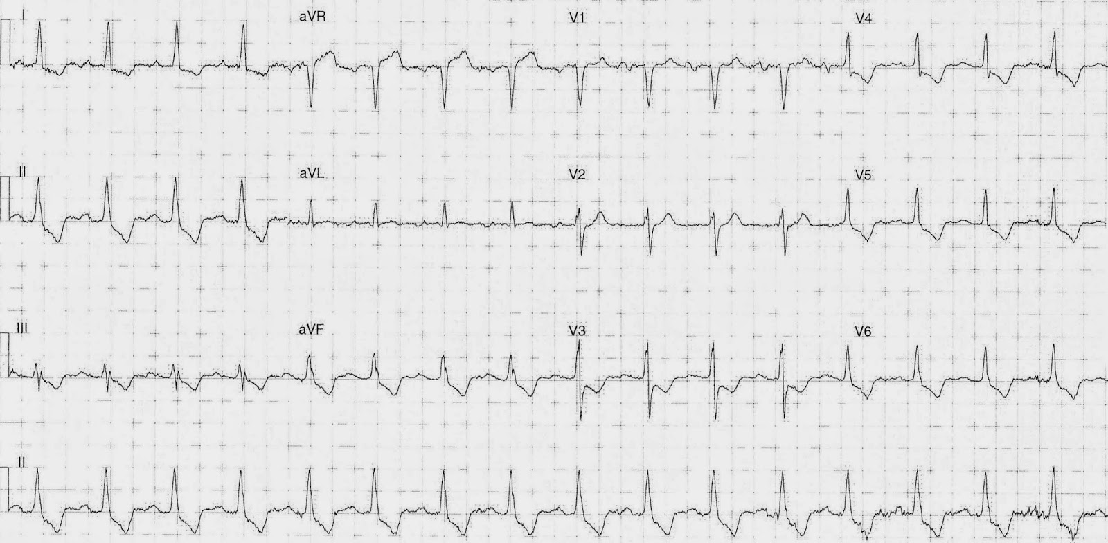 ECG of the Week: ECG of the Week - 9th March 2015