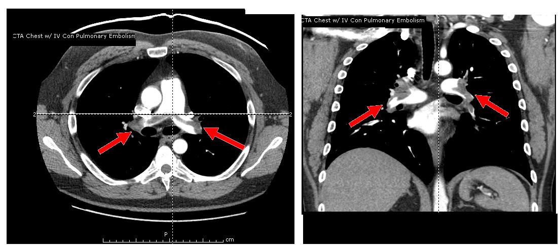 ECG Rhythms: Pulmonary Embolism