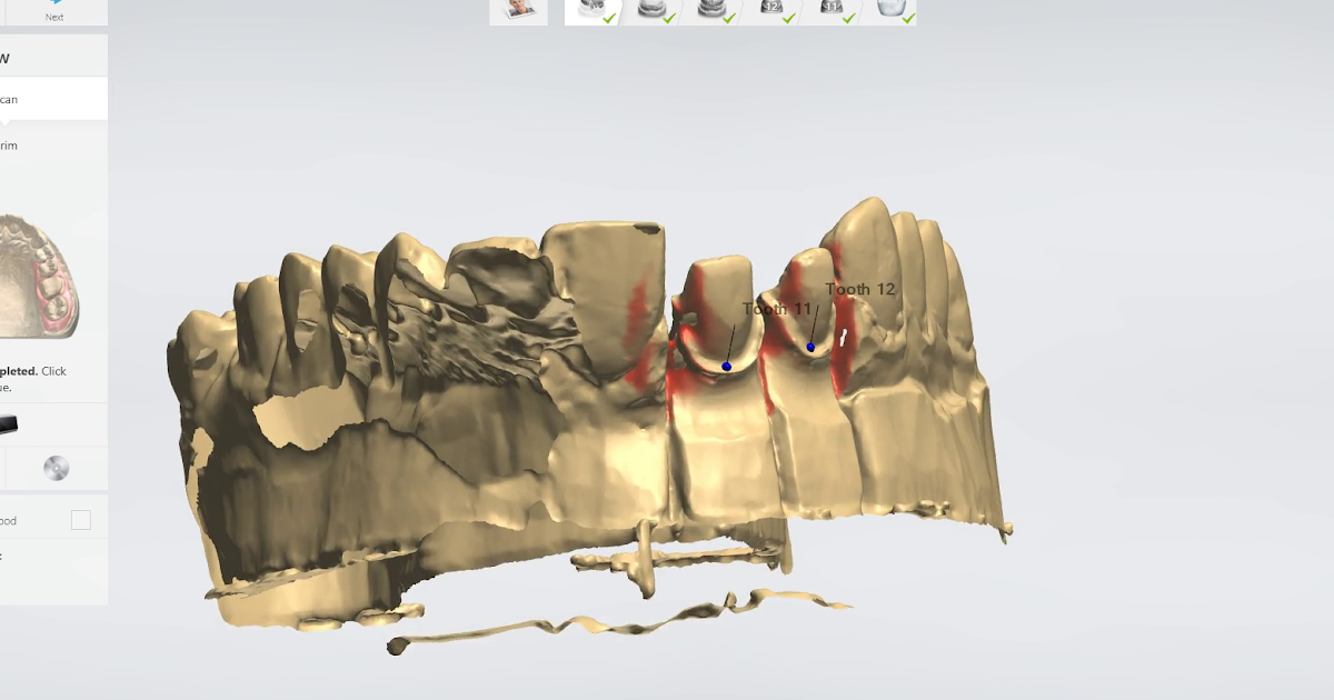 Precise scan with proclined teeth in 3shape scanner