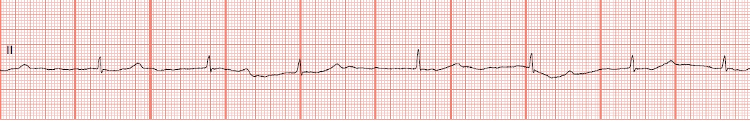 ECG Rhythm Strip Quiz 65