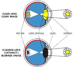 Homeopathy , Bach Flower , Nutritional Healings: Introduction To Cataract