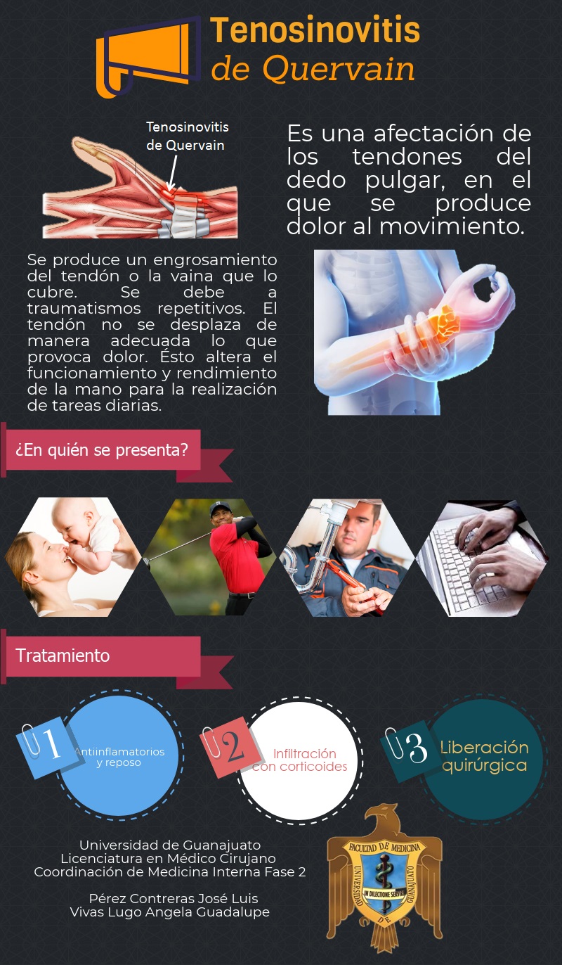 DIVULGACIÓN CIENTÍFICA UG: Tenosinovitis de Quervain