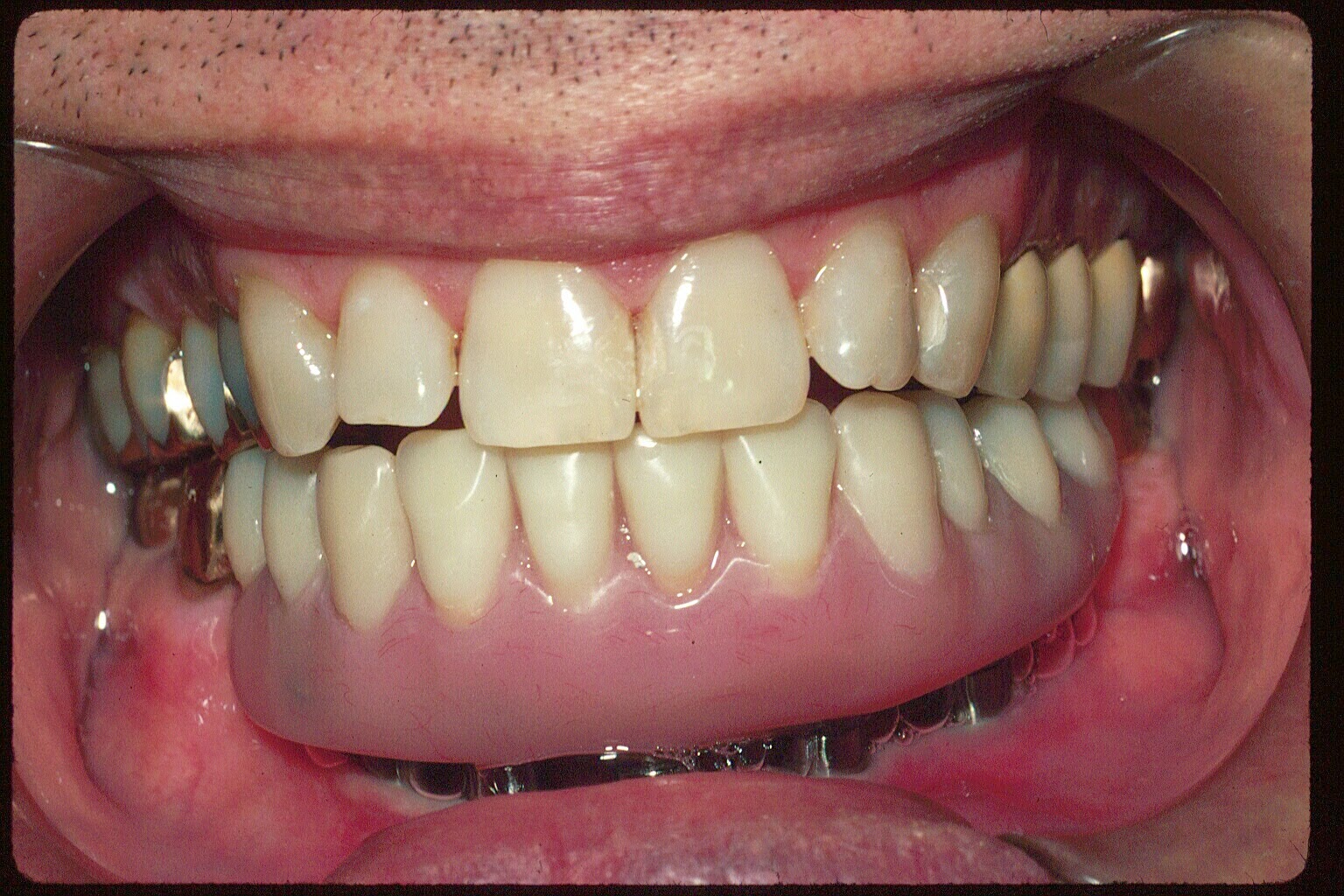 Dr. Robert G. Tupac: Prosthodontics: Prosthodontists Restore Surgical ...