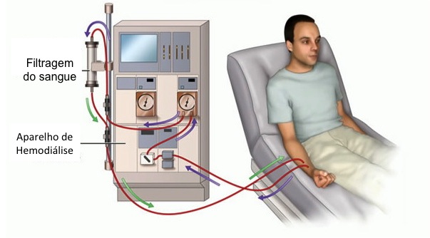 Salud Renal: Estilo de Vida en Hemodiálisis