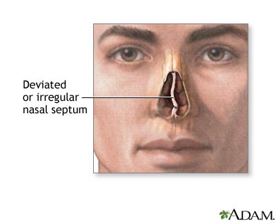 Deviasi septum (askep) | Link Kesehatan