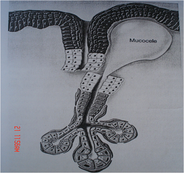 Dentistry and Medicine: Notes on Mucocele and Mucous Retention cyst ...