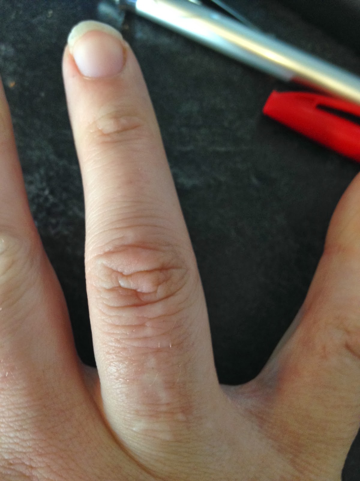 Recommendation Info About How To Tell If I Broke My Finger - Matehope54